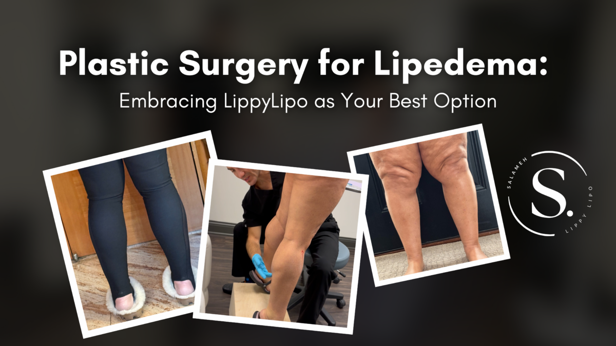 Lipedema - Salameh LippyLipo