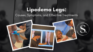 Understanding Lipedema Legs: Causes, Symptoms, and Treatment - Salameh ...